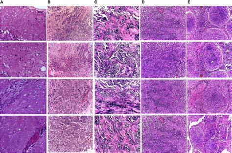 Medulloblastoma Pathology Outlines