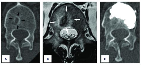 A Pretreatment Axial Ct Demonstrates A Schmorls Node Black Arrows