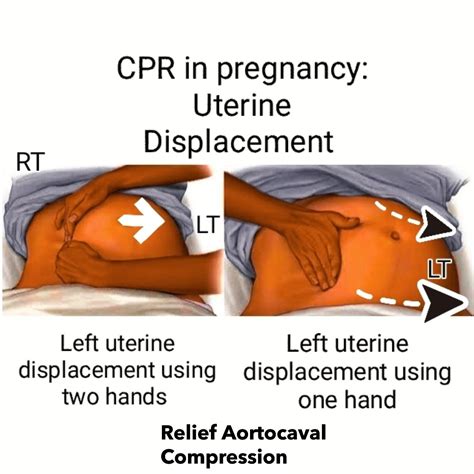 Moustafa Mahmoud Sappaq On Linkedin Left Uterine Displacement Lud