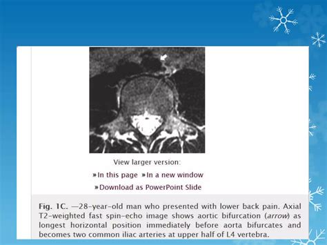 Transitional Vertebrae Radiology Pptx