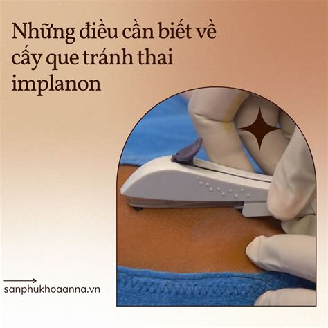 Những điều Cần Biết Về Cấy Que Tránh Thai Implanon