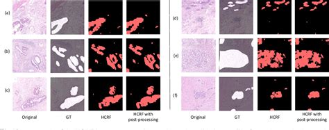 Figure 12 From Gastric Histopathology Image Segmentation Using A