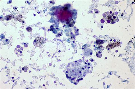 Cryptococcosis Smear From Lung Fna Pap Stain Of Direct Sm… Flickr