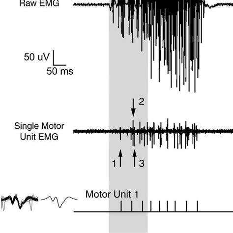Sample Single Motor Unit Recordings With Compound Emg Activity During