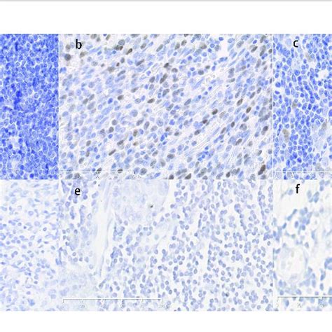 The Mrna Expression Profile In Thymoma Patients And Normal Thymic Download Scientific Diagram