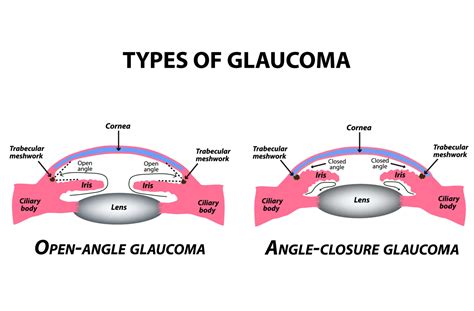 What Is Primary Open Angle Glaucoma Poag
