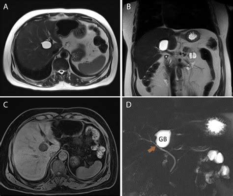 Intrahepatic Gallbladder Mimicking A Cystic Liver Lesion A Case Report