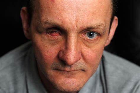 Man Left With Only One Eye Following Frenzied Street Attack Wales Online