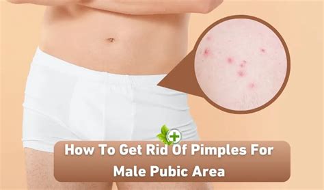 How To Get Rid Of Pimples For Males Pubic Area Ulti Health Guide