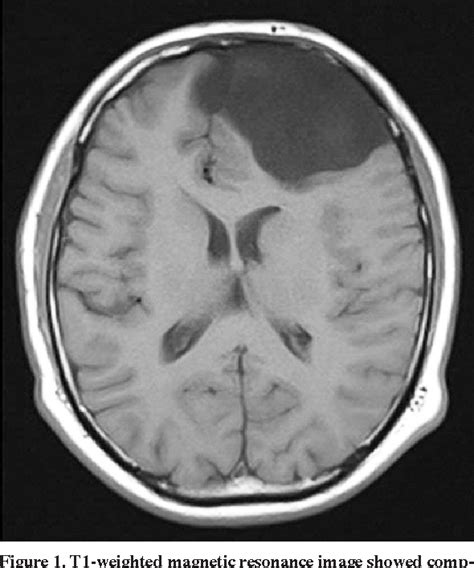 Figure 3 From Left Frontal Convexity Arachnoid Cyst Extending To Interhemispheric Fissure