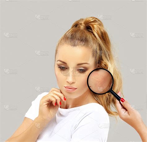 痤疮疤痕后治疗痤疮疤痕。痤疮疤痕切除