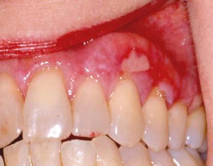 Oral Lichen Planus