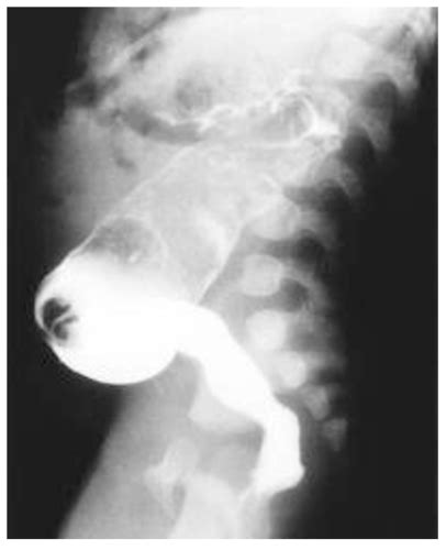 Oms 2 Spring 24 Block 8 Cpc Pediatric Digestive Disease Flashcards