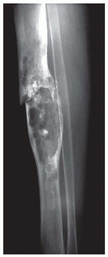 Chondrosarcoma Primary Secondary Dedifferentiated And Clear Cell Musculoskeletal Key