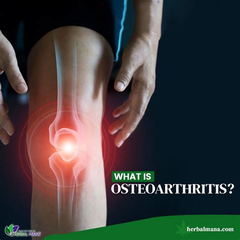 What Is Osteoarthritis Symptoms Causes Natural Remedies Artofit