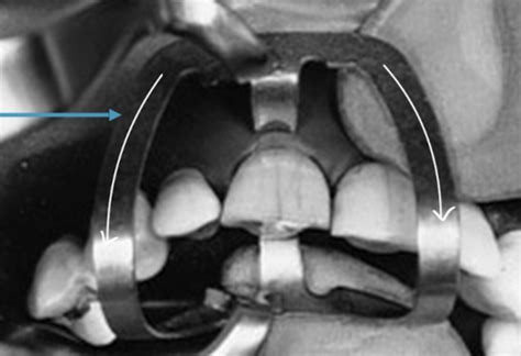10 Class V Composite Restorations Flashcards Quizlet