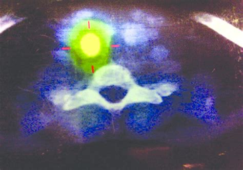 Single Photon Emission Computed Tomography Showing Evidence Of Uptake