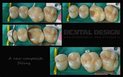 How Is A Composite Filling Made Dr Bogdan Fondrea