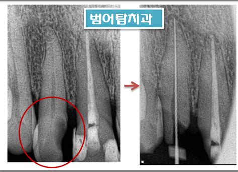 신경근관치료 범어탑치과