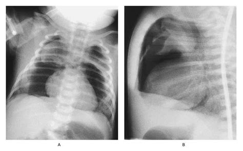 Neonatal Pneumomediastinum Nejm