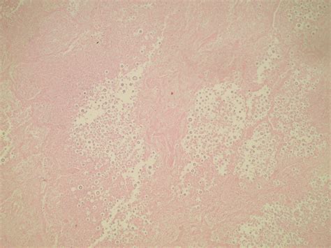 Pathology Outlines Cryptococcus