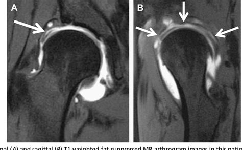 Figure 3 From Acetabular Labrum Semantic Scholar