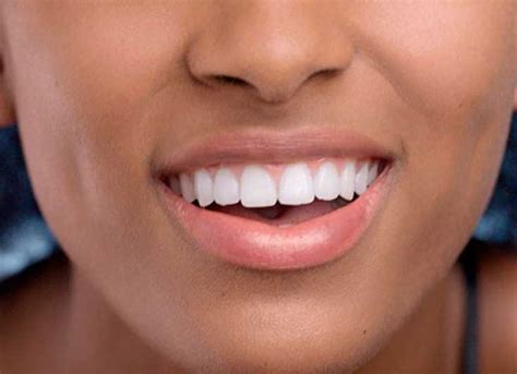 Black Gums And Spots On Gums Causes Treatment And Reasons