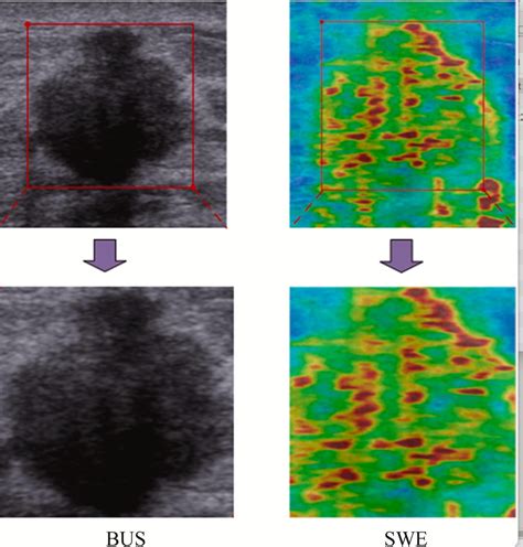 Can An Ai Combination Of Ultrasound And Molecular Data Predict Chemotherapy Response In Breast