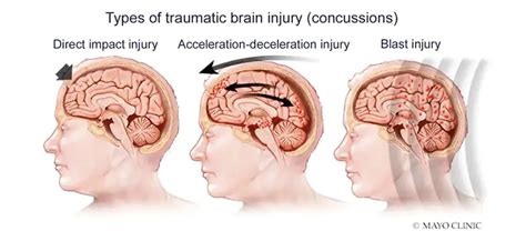 Different Types Of A Tbi Horizon Tbi And Brain Center