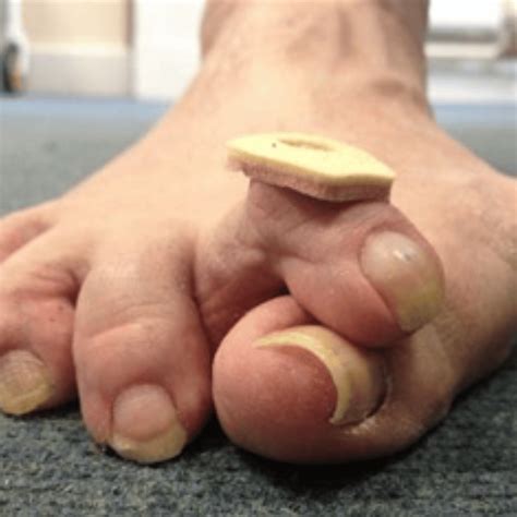 Toe Deformities Thames Foot Clinic