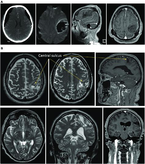Illustration Of The Brain Lesion Of Mr I Panel A Onset Ct Scan Of Download Scientific