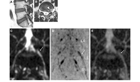 Diffusion Weighted Image Of A Lumbar Nerve Root In A 47 Yearold Man Download Scientific Diagram