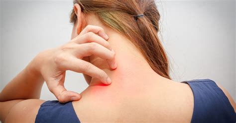 Candidiasis Of The Skin Causes Symptoms Diagnosis And Treatment
