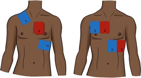 Defibrillation In The Cardiac Arrest Patient Emergency Medicine Clinics