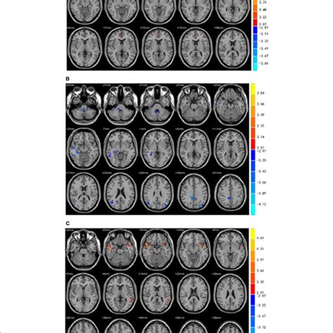 Functional Connectivity Analysis A Using Right Putamen As The Seed Download Scientific