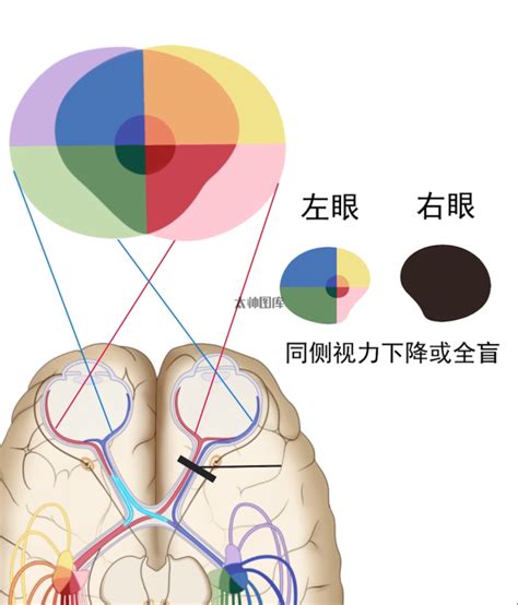 不同部位视觉传导通路受损症状 医学插画
