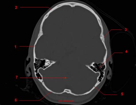 Skull CT Anatomy W Radiology