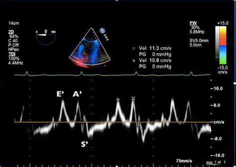 Tissue Doppler Velocity Imaging And Event Timings In 49 Off
