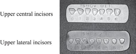 Figure 1 From Influence Of Shovel Shaped Incisors On The Dental Arch