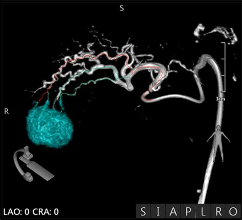 Advanced Interventional Software Interventional Oncology Radiology Angiography