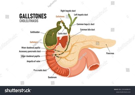 Cholelithiasis Cholecystitis Formations Gallbladder Blockage Bile Stock