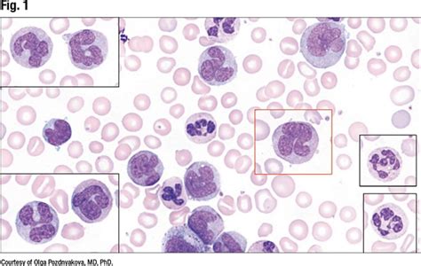 Close Up On Abnormal Monocyte Morphology In Peripheral Blood Smears