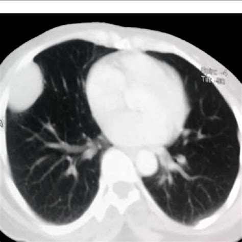 Axial View Of Chest Ct Scan Shows A Right Pleuralbased Mass Download