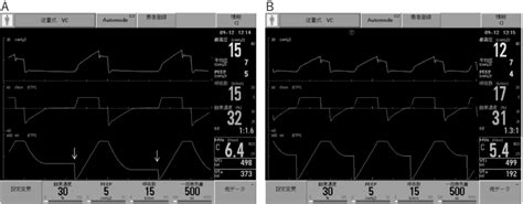 Graphical Examples Of Patient Ventilator Asynchrony Airway Pressure