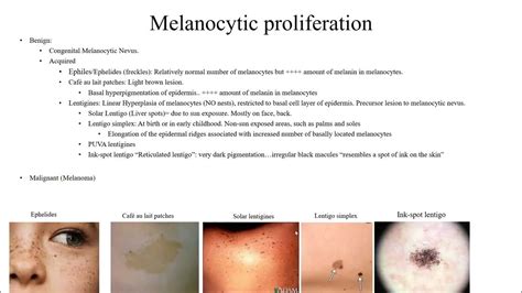 Pathology Made Easy Systemic Pathology 14 Skin Diseases 5 Epidermal Neoplasms 2 Melanocytic