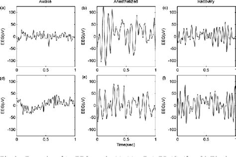 Figure From Frontal Temporal Synchronization Of EEG Signals Quantified By Order Patterns Cross