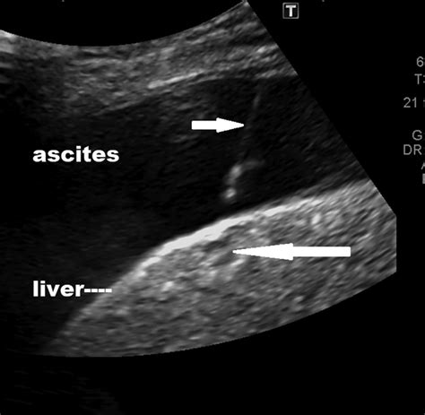 Showing Ultrasound Guided Fine Needle Aspiration From The Liver Of A Download Scientific