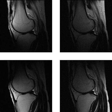 Figure 5 From Reconstruction Of Parallel Mri Images Using High