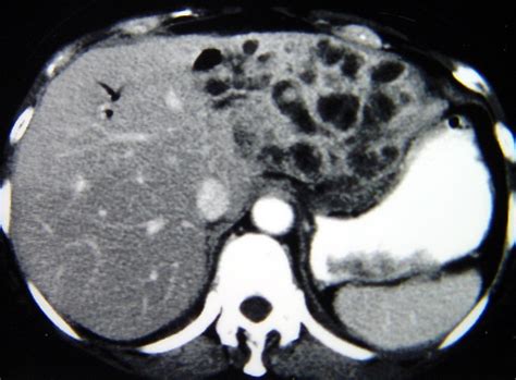 Liver Surgery Photos