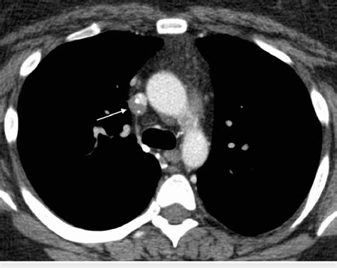 Axial View Of A Ct Chest Showing An Eccentric Partially Calcified Download Scientific Diagram